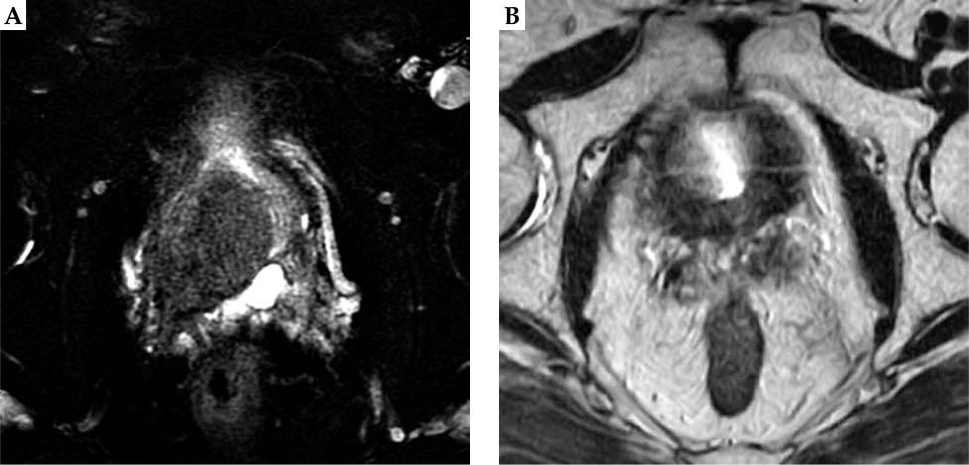 Very High Risk Locally Advanced Prostate Ductal Adenocarcinoma Cured Using Low Dose Rate