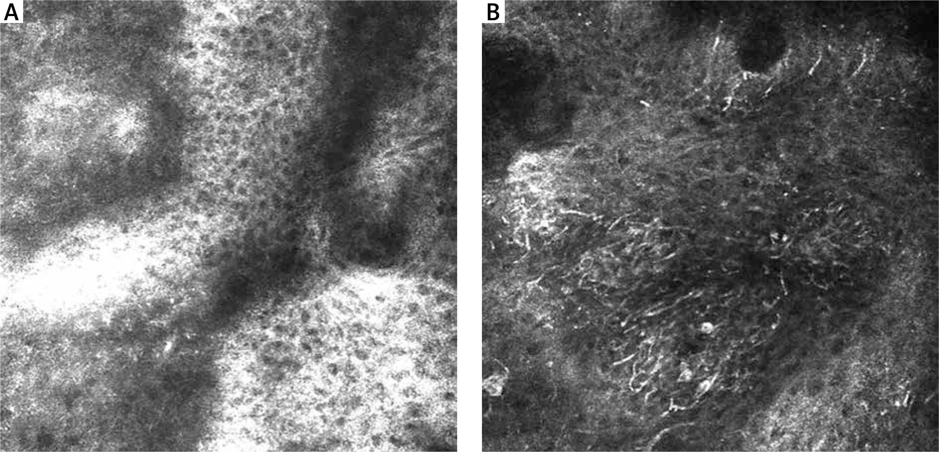Spitz nevus and melanoma: evaluation with dermoscopy and reflectance ...
