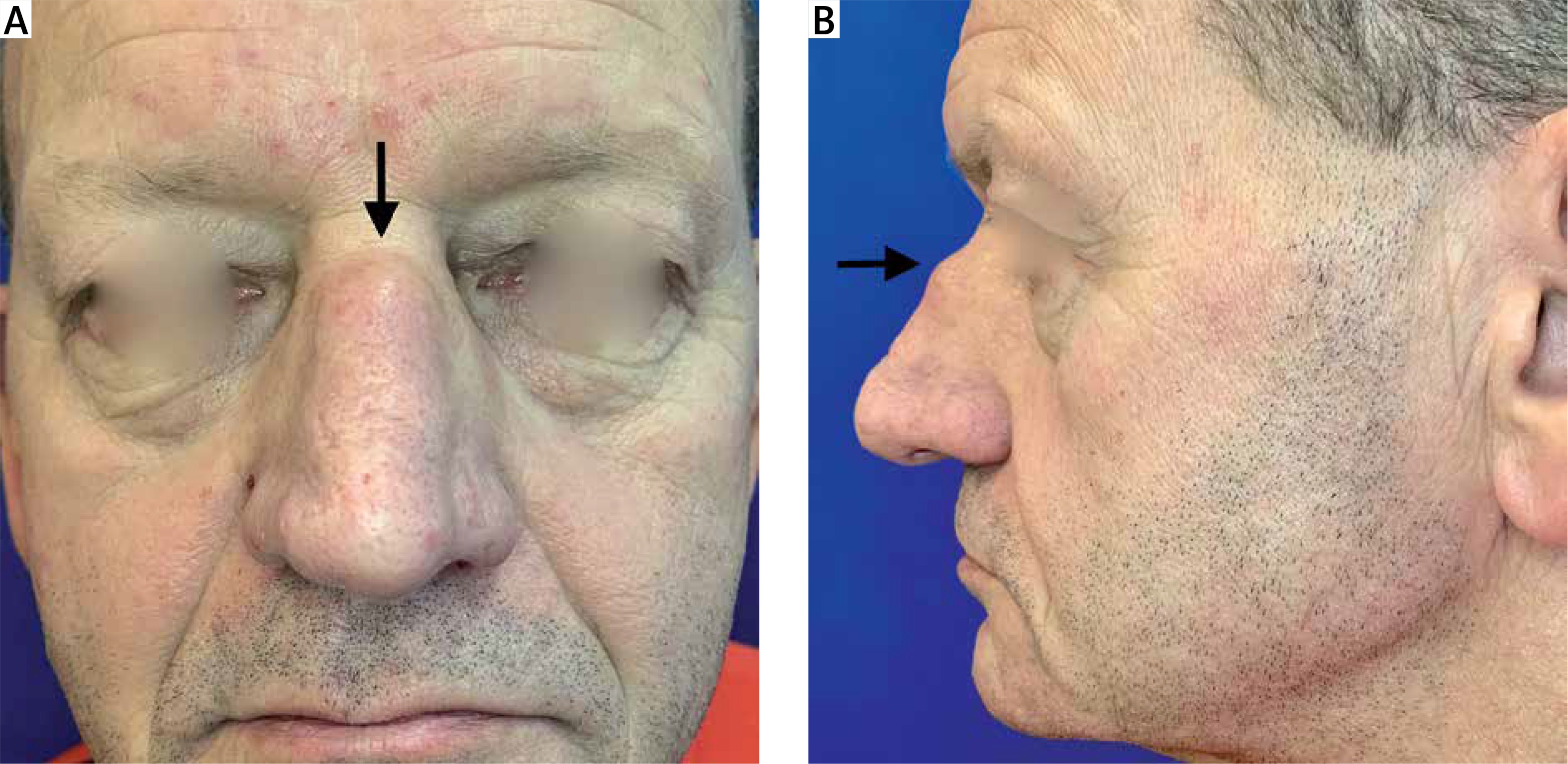 Combined minimally invasive surgical management of a nasal dermoid ...